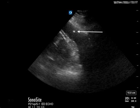 Pocus For The Win Ultrasound Guided Pericardiocentesis For Cardiac