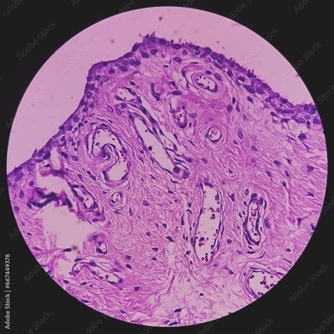 Synovial Tissue Biopsy Villonodular Synovitis Ganglion Cells Smear