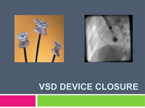 Vsd Device Closure Pptx