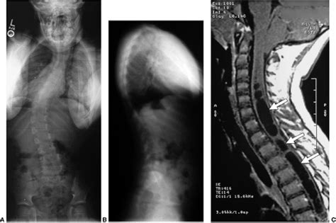 Idiopathic Scoliosis Teachme Orthopedics