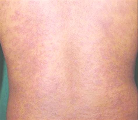 Resolving Rash Of Drug‑induced Pityriasis Rosea At The End Of 1 Week