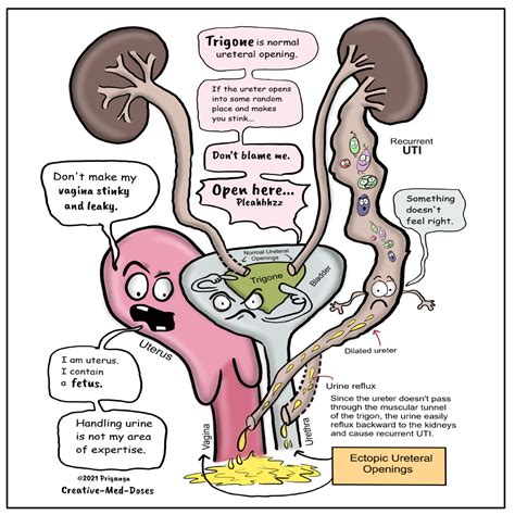 Ureterocele Creative Med Doses