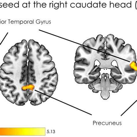 Statistical Parametric Maps Of Seed Based Analysis And Multiple