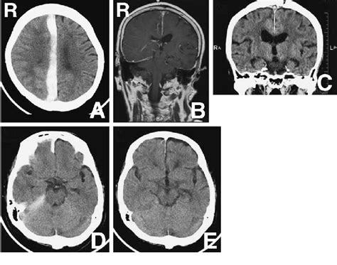 Axial Head Computed Tomography Ct Scans On Admission Showing A