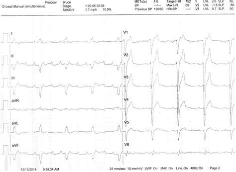 Trifascicular Block Ecg Pedia At Brandon Myers Blog