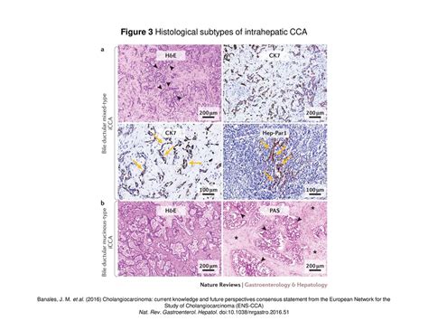 Figure 3 Histological Subtypes Of Intrahepatic Cca Ppt Download