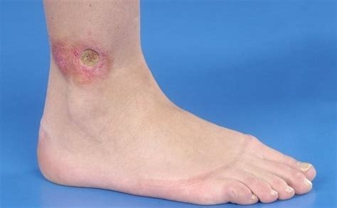 Diabetic Skin Rash Pictures Effective Health