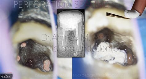 The Problems Of Pulpotec Material Style Italiano Endodontics