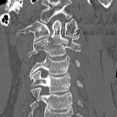 Odontoid C2 Fracture Clinical Tree