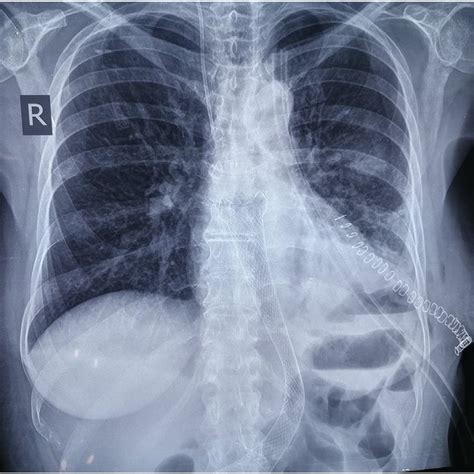 Post Operative Cxr Showing Full Lung Expansion The Stent In Its Place