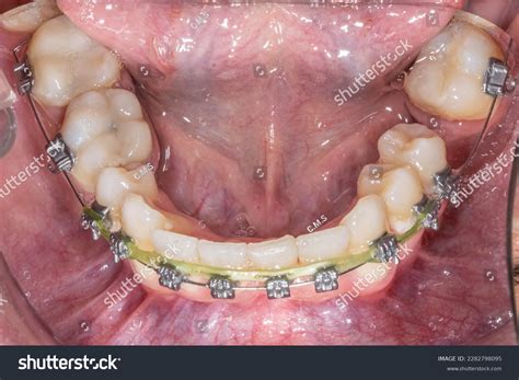 Frenulum Linguae