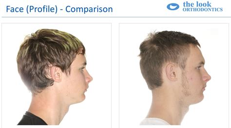 Before And After Overjet Profile