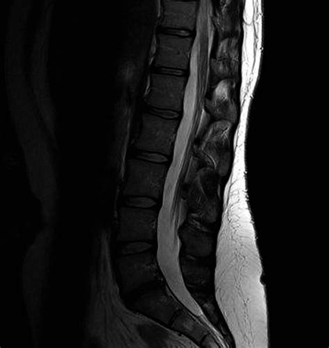 Anterior Spinal Column Reconstruction Anterior Lateral And Oblique