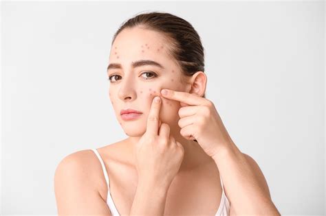 Nguyên Nhân Gây Mụn Li Ti Kem Trị Mụn Li Ti Nào Mang Lại Hiệu Quả