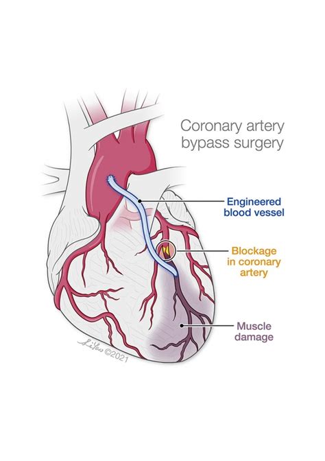 Coronary Artery Bypass Surgery Li Yao
