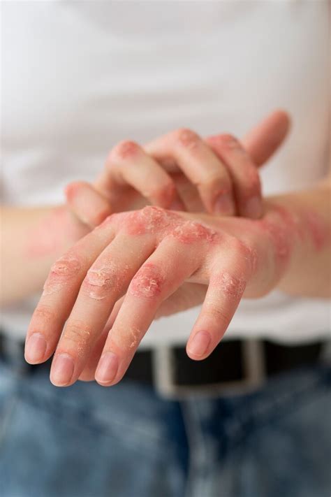 Грибковый дерматит причины симптомы лечение Блог мед центра Альтернатива