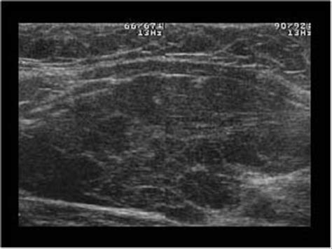 Thyroid Ultrasound Hashimotos Pediatrics 9 5 Pediatric Head And Neck