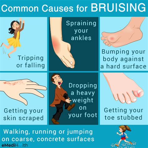Possible Reasons And Risk Factors For Bruises Emedihealth
