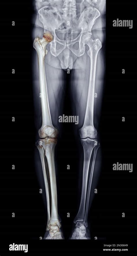 Scanogram Is A Full Length Standing AP Radiograph Of Both Lower