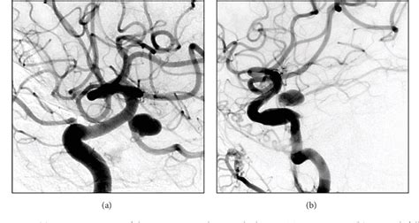 Figure From Failure Of The Pipeline Embolization Device In Posterior Communicating Artery