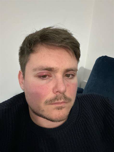 Never Had Eye Issues Before Is This Blepharitis R Blepharitis