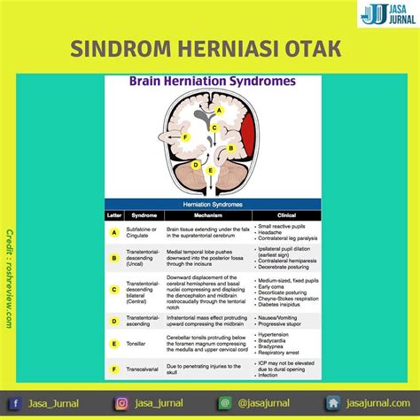 Translate Dokter Umum And Gigi On Instagram “sindrom Herniasi Batang Otak” Instagram Otak
