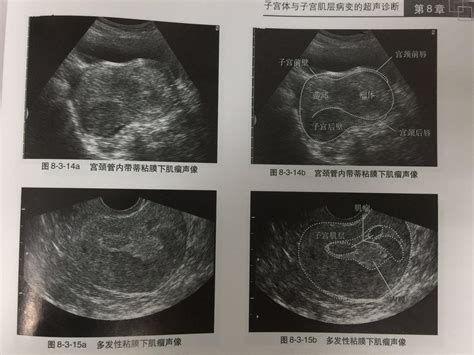超声子宫肌瘤 知乎