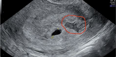 Need Advice 5w Placement Ultrasound Sac Not Fully Attached R