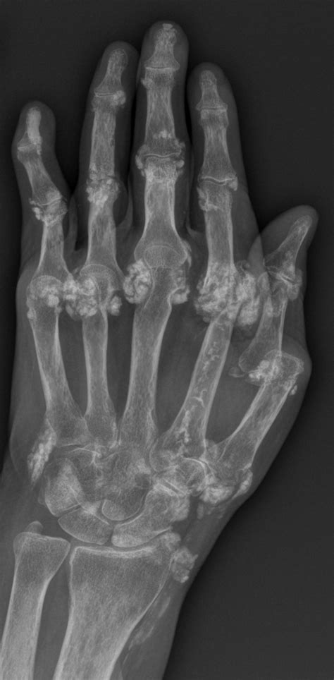 Scleroderma Radiology Case