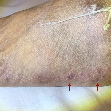 Histopathology Of The Palpable Purpura Which Exhibited A Cleft In A