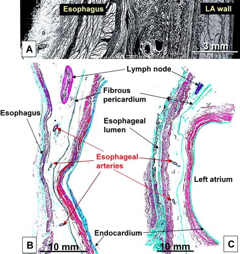 Anatomic Relations Between The Esophagus And Left Atrium And Relevance