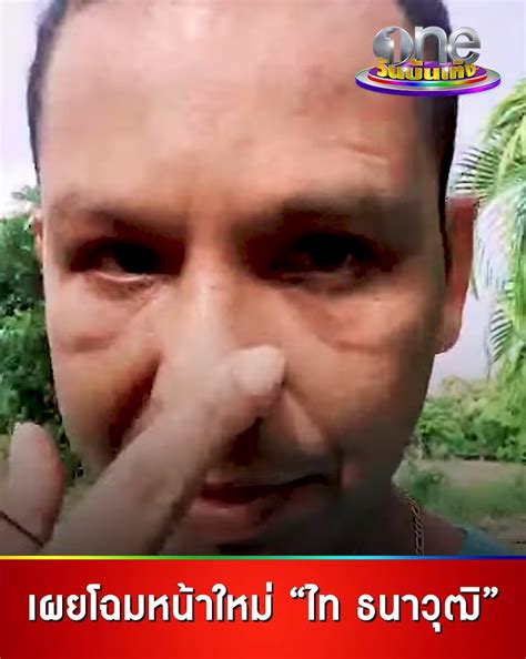 ไท ธนาวุฒิ เปิดโฉมหลังศัลยกรรม ตอนนี้ตาหวานฉ่ำ มั่นใจใต้ตาไม่โบ๋แล้ว