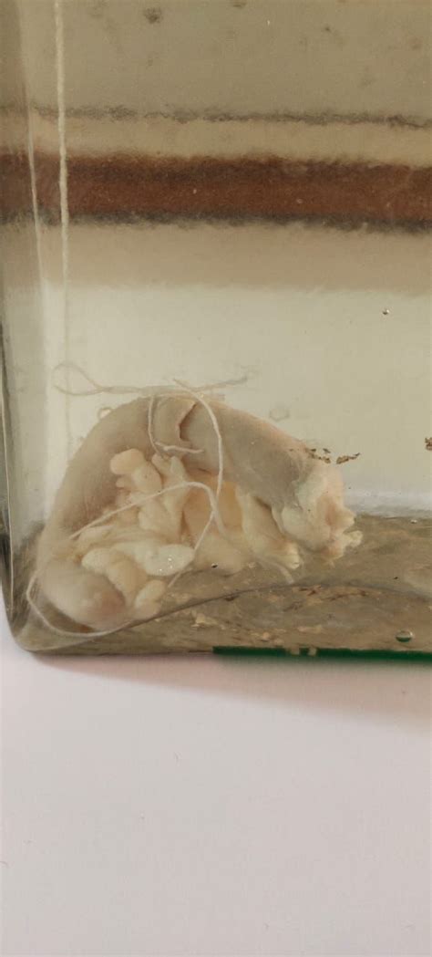 Khushi Ambastha On Linkedin Case Of Acute Appendicitis The