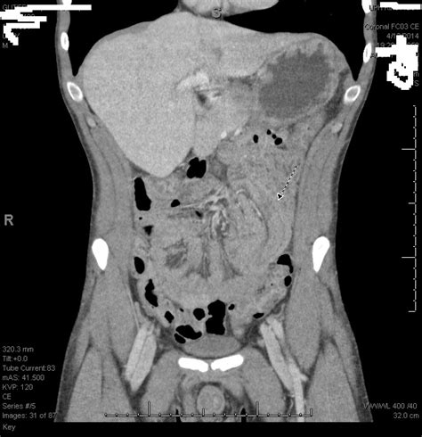Intussusception Surgery Photos
