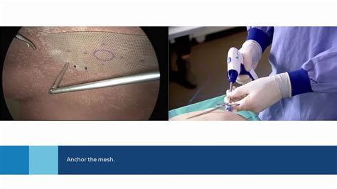 Medtronic Parietene Ds Composite Mesh For Hospital At Best Price In Mumbai