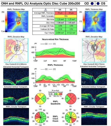 Diabetes Induced Retinal Ischemia Decision Maker Plus