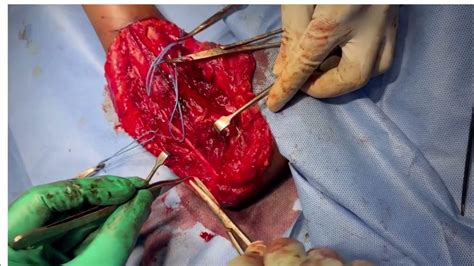 Hyperselective Neurectomy For Spastic Flexion Pronation Deformity Of The Forearm And Wrist Youtube