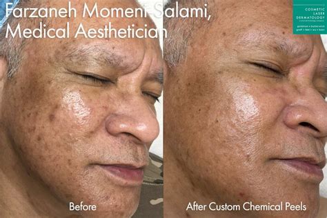 Deep Chemical Peel Before And After Purchase