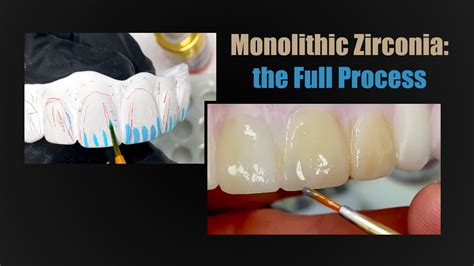 Zirconia Crowns Procedure