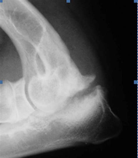 Elbow Ununited Anconeal Process 02 Radiograph Lateral In Dogs Canis