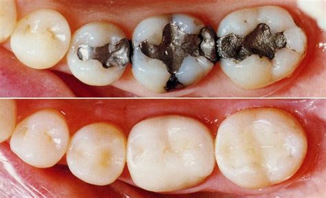 Tooth Fillings Brookdale Dental Boise Id 208 373 0018