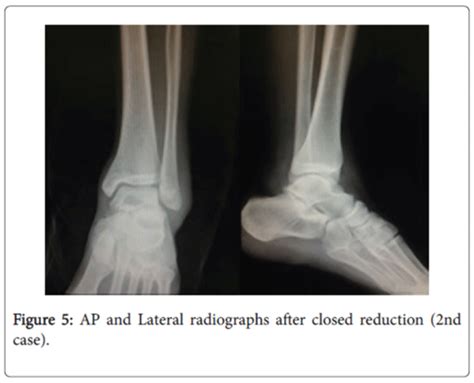 Ankle Dislocation Reduction