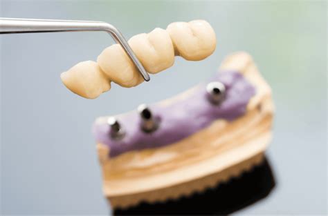 What Is The Bridge Sectioning Dental Code A Detailed Guide