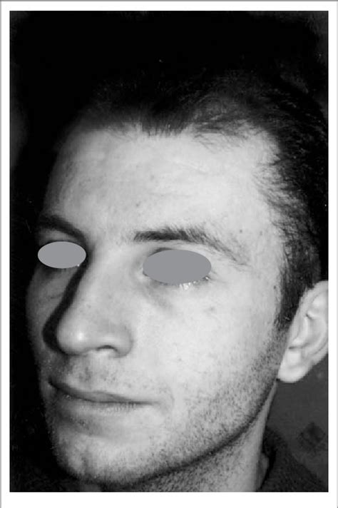 Figure 13 From Reconstruction Of Partially Amputated External Ear With
