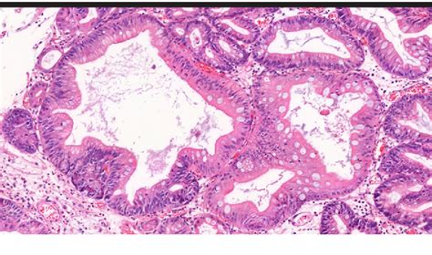 Figure 2 From Gastric And Small Intestinal Traditional Serrated