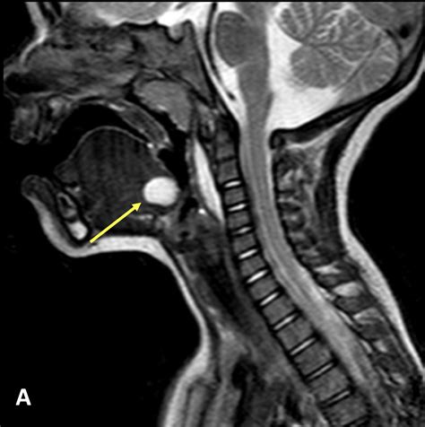 Thyroglossal Duct Cyst Tdc Mri Online Medality