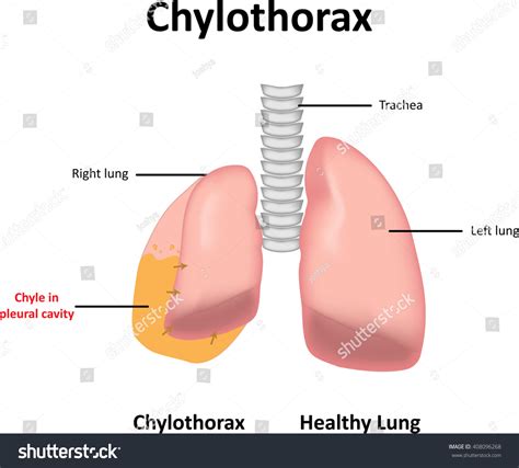 Chylothorax Illustration Stock Vector Royalty Free 408096268