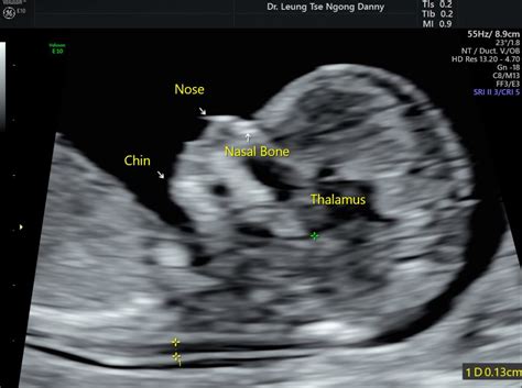 Absence Of Fetal Nasal Bone Hypoplastic Nasal Bone Hkog Info