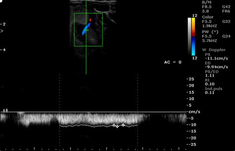 Color Doppler Ultrasound Image Showing Hemodynamic Measurements From