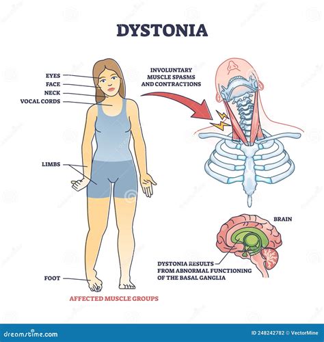 Dystonia Disorder As Abnormal Muscle Spasms And Contractions Outline